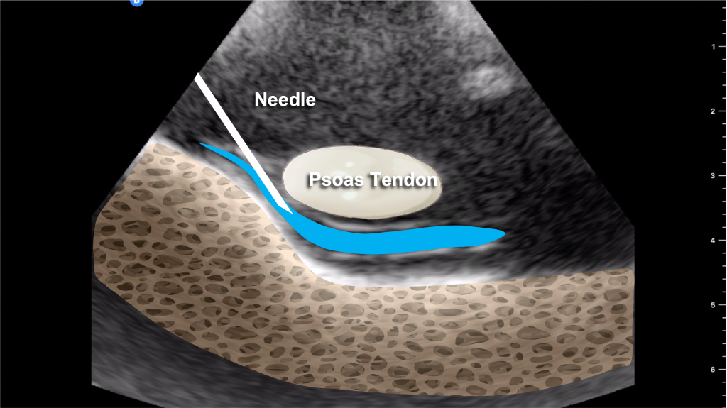 Inicio Anestesia regional Entrenador de bloques PENG